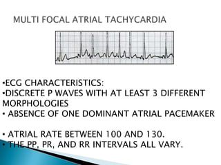 ECG: Digitalis Effect / MAT / AF | PPT