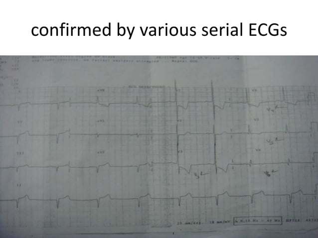 ECG: Situs Inversus Atrialis | PPTX