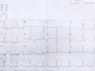 ECG - Mobitz Type II block | PPT