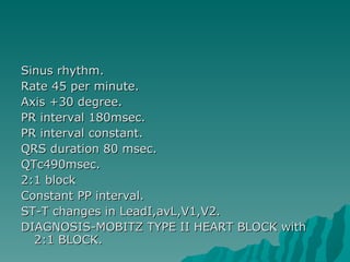 ECG - Mobitz Type II block | PPT