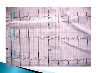 ECG: Digitalis Effect | PPT | Heart and Cardiovascular Diseases ...