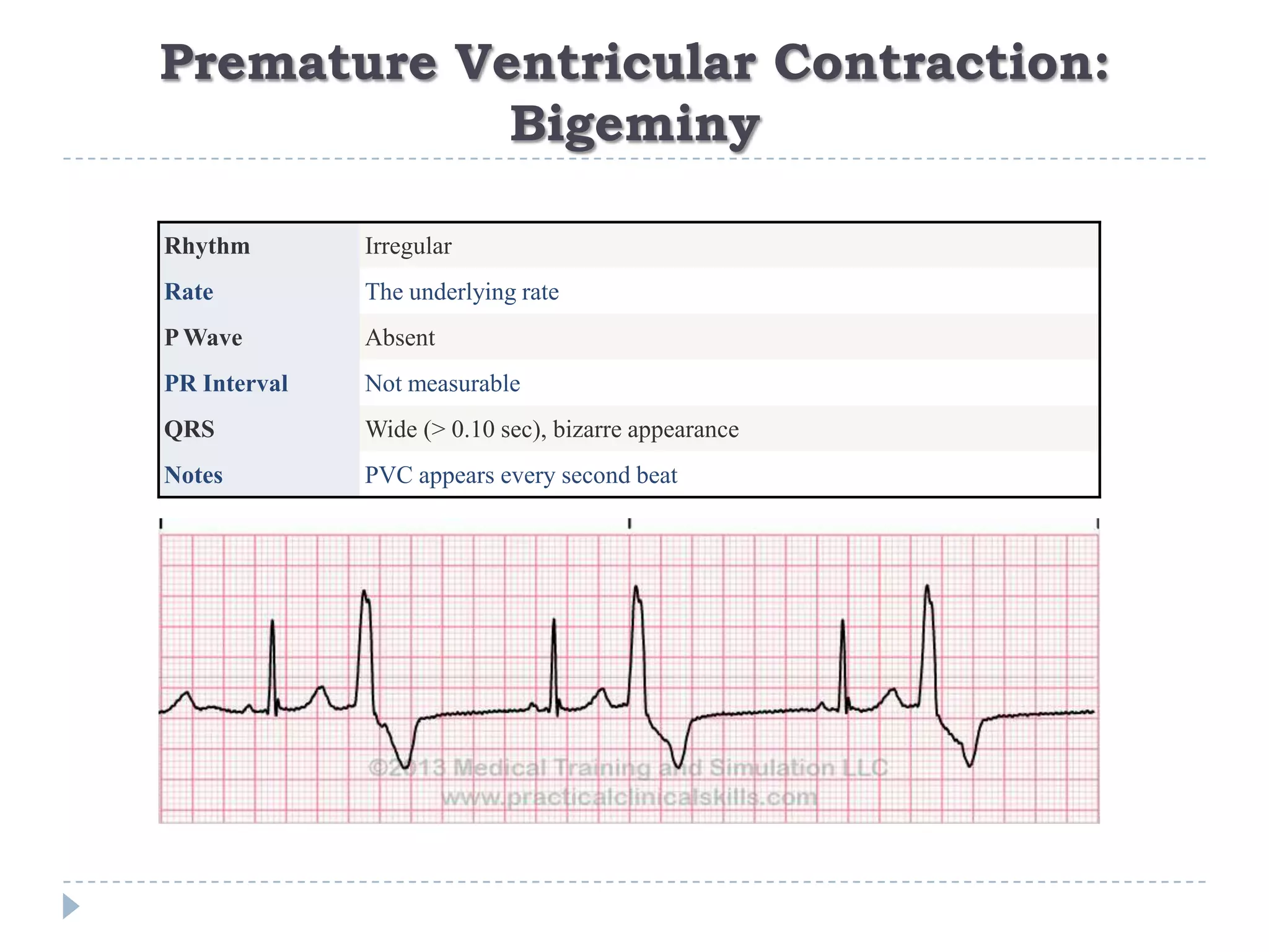 Ecg or ekg sample strips (MS Cardiovascular) | PPTX
