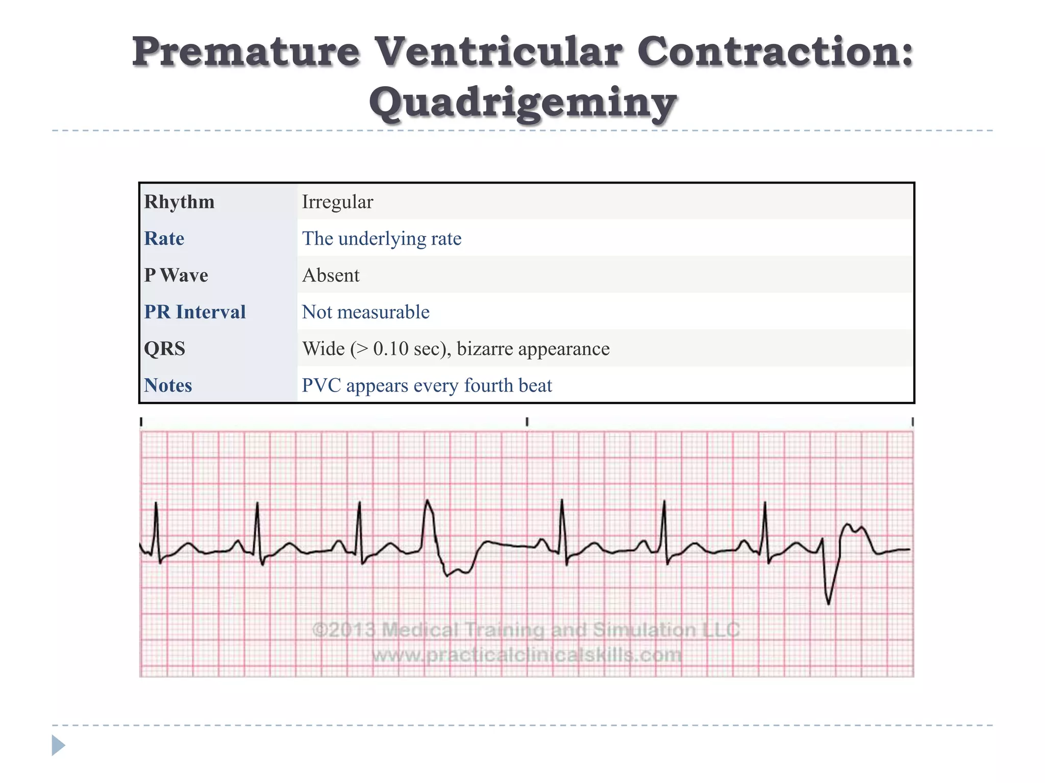 Ecg or ekg sample strips (MS Cardiovascular) | PPTX