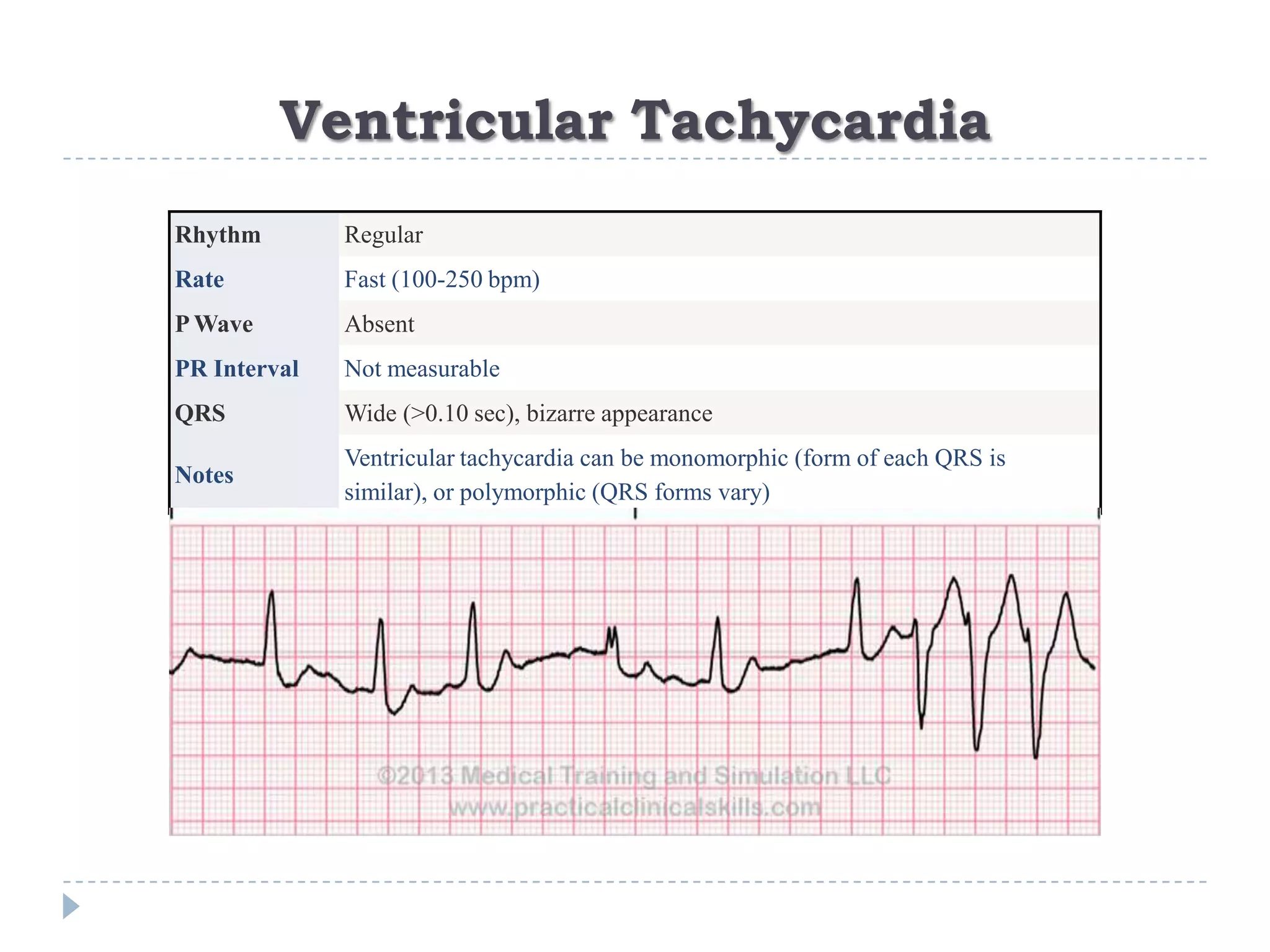 Ecg or ekg sample strips (MS Cardiovascular) | PPTX