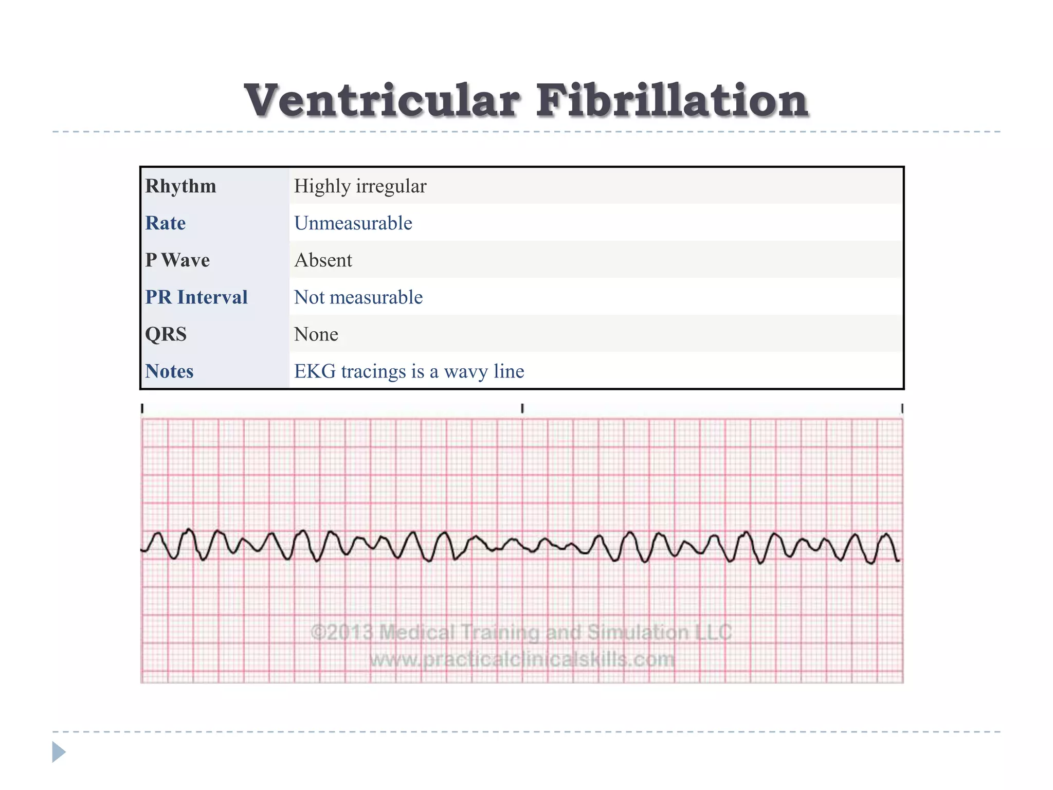 Ecg or ekg sample strips (MS Cardiovascular) | PPTX