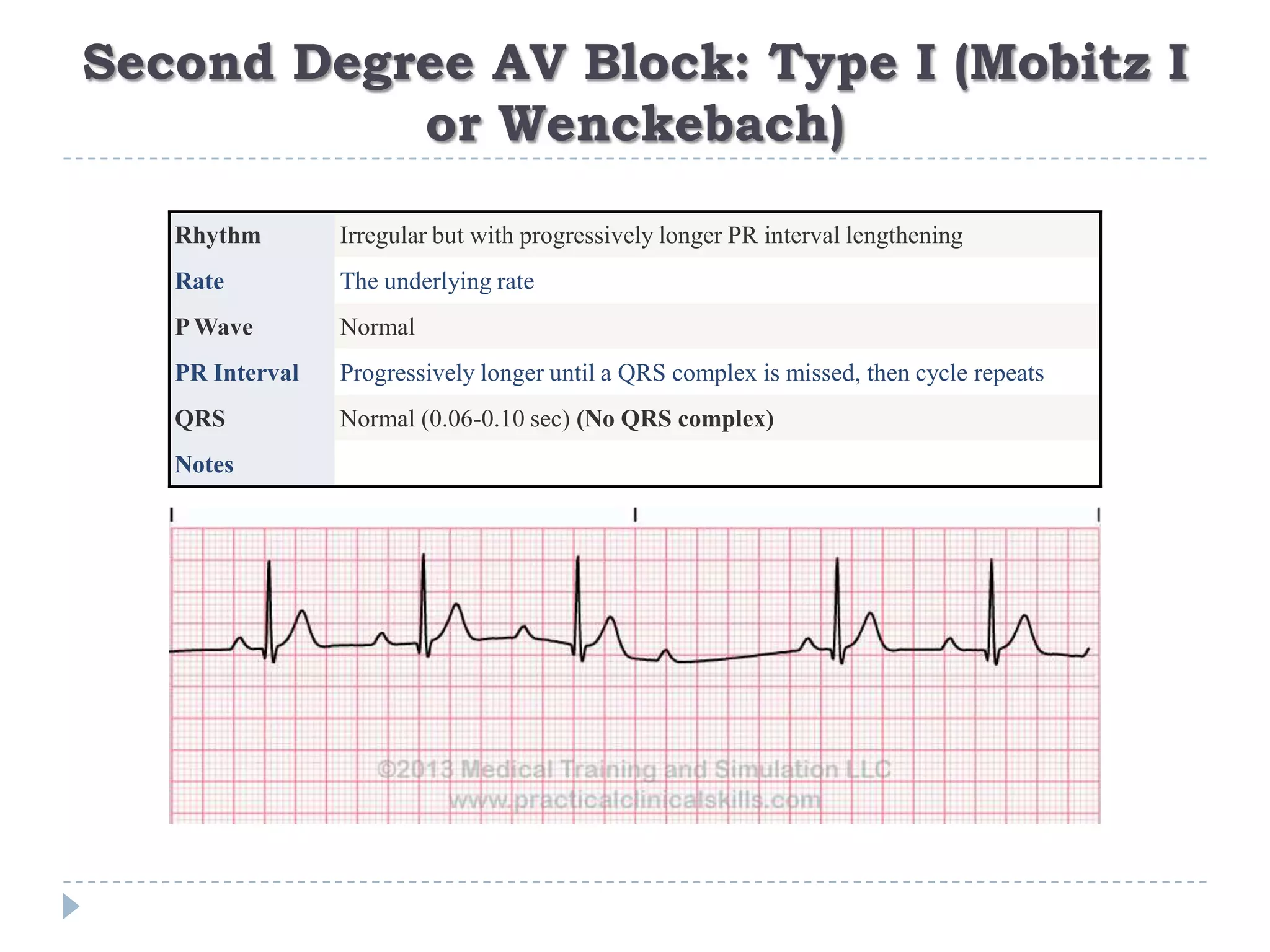 Ecg or ekg sample strips (MS Cardiovascular) | PPTX
