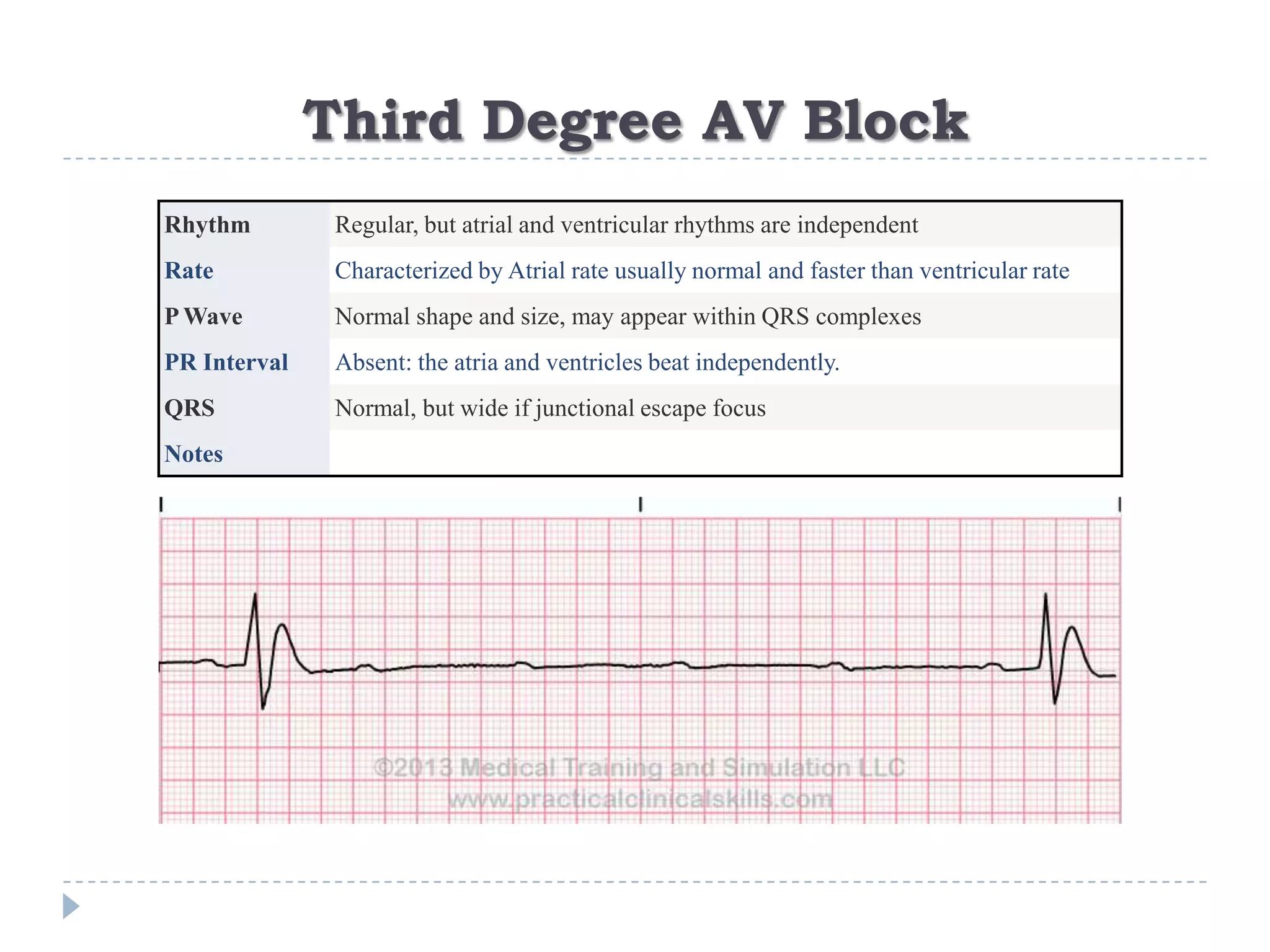 Ecg or ekg sample strips (MS Cardiovascular) | PPTX