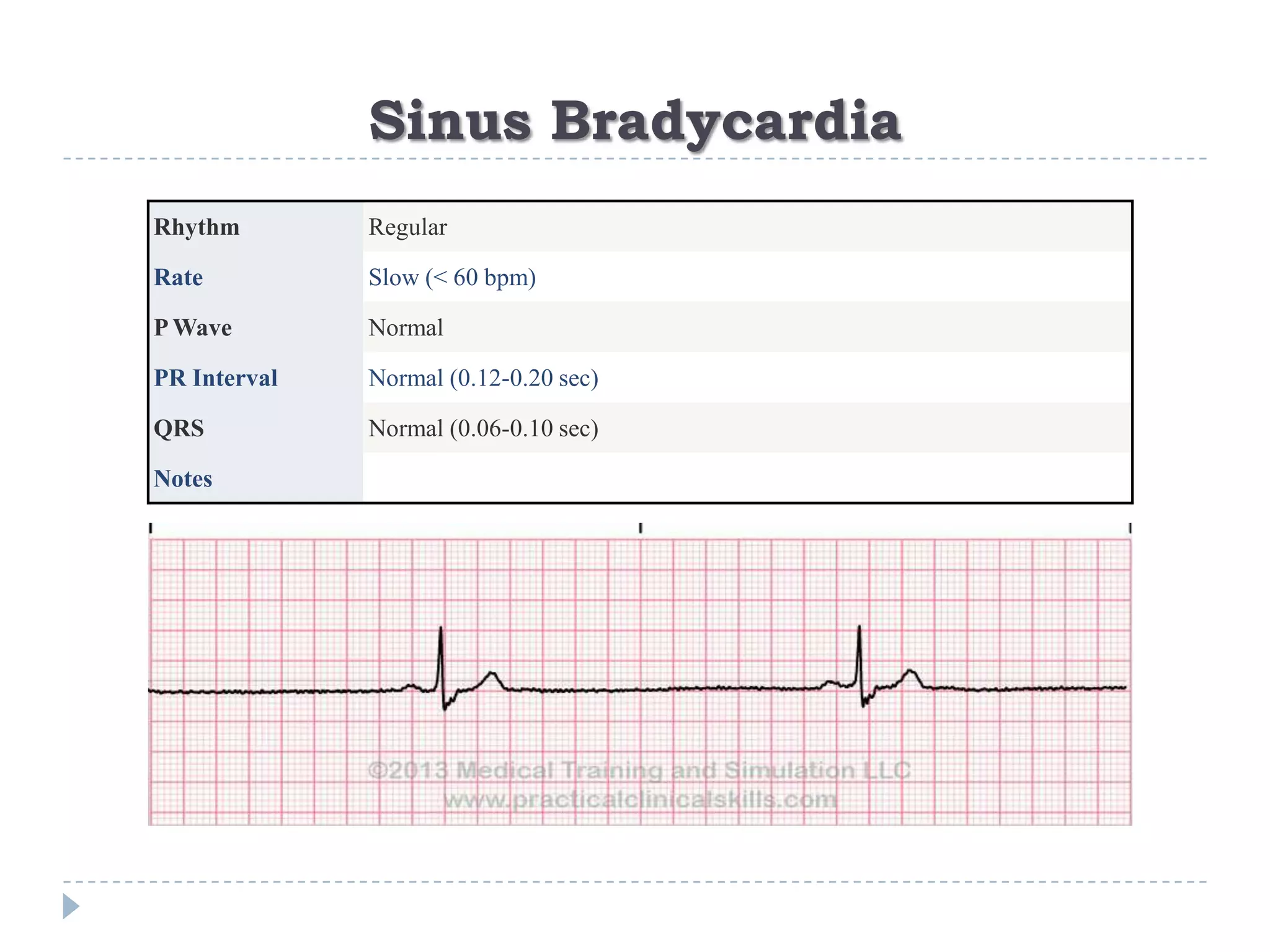 Ecg or ekg sample strips (MS Cardiovascular) | PPTX