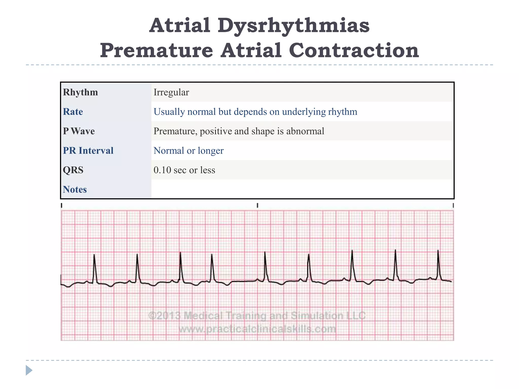 Ecg or ekg sample strips (MS Cardiovascular) | PPTX