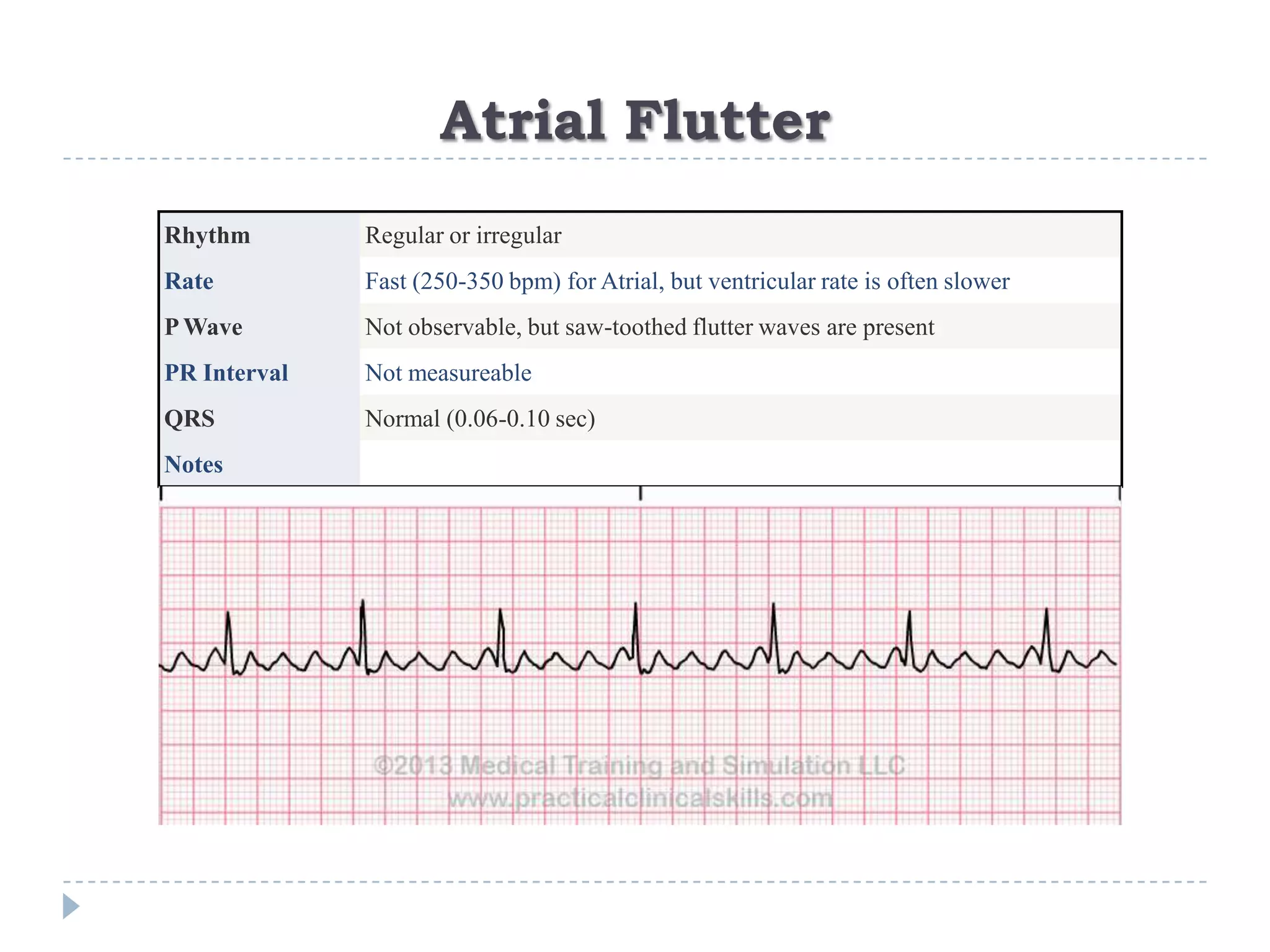 Ecg or ekg sample strips (MS Cardiovascular) | PPTX