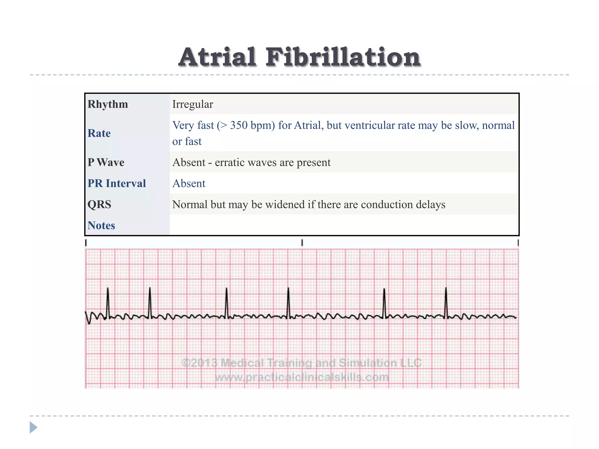 Ecg or ekg sample strips (MS Cardiovascular) | PPTX