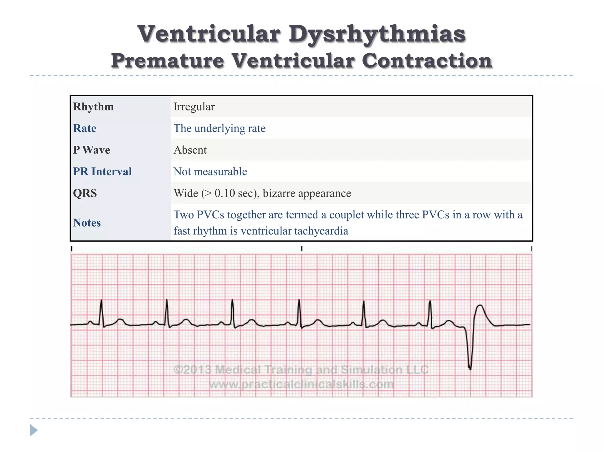 Ecg or ekg sample strips (MS Cardiovascular) | PPTX
