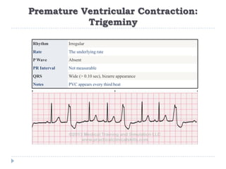 Ecg or ekg sample strips (MS Cardiovascular) | PPTX