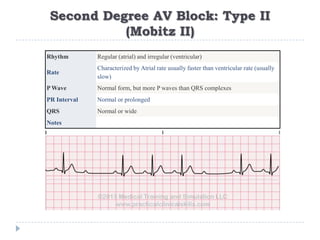 Ecg or ekg sample strips (MS Cardiovascular) | PPTX