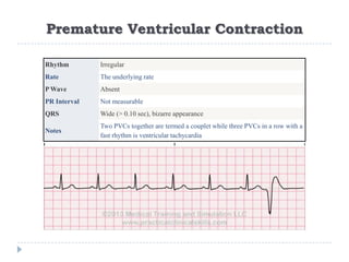 Ecg or ekg sample strips (MS Cardiovascular) | PPTX | Heart and ...