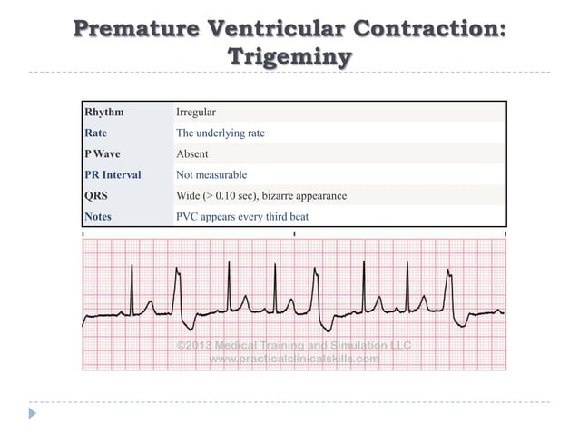 Ecg or ekg sample strips (MS Cardiovascular)