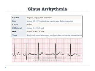 Sinus Arrhythmia Rhythm Strip