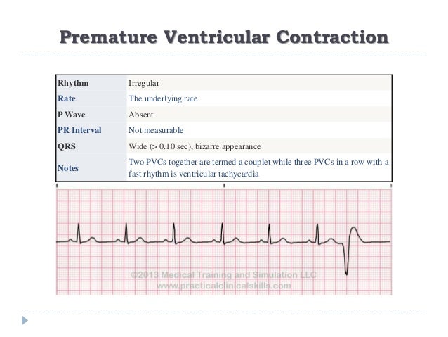 Ecg or ekg sample strips (MS Cardiovascular)