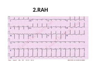 ECG. PAPERS. long presentation | PPT