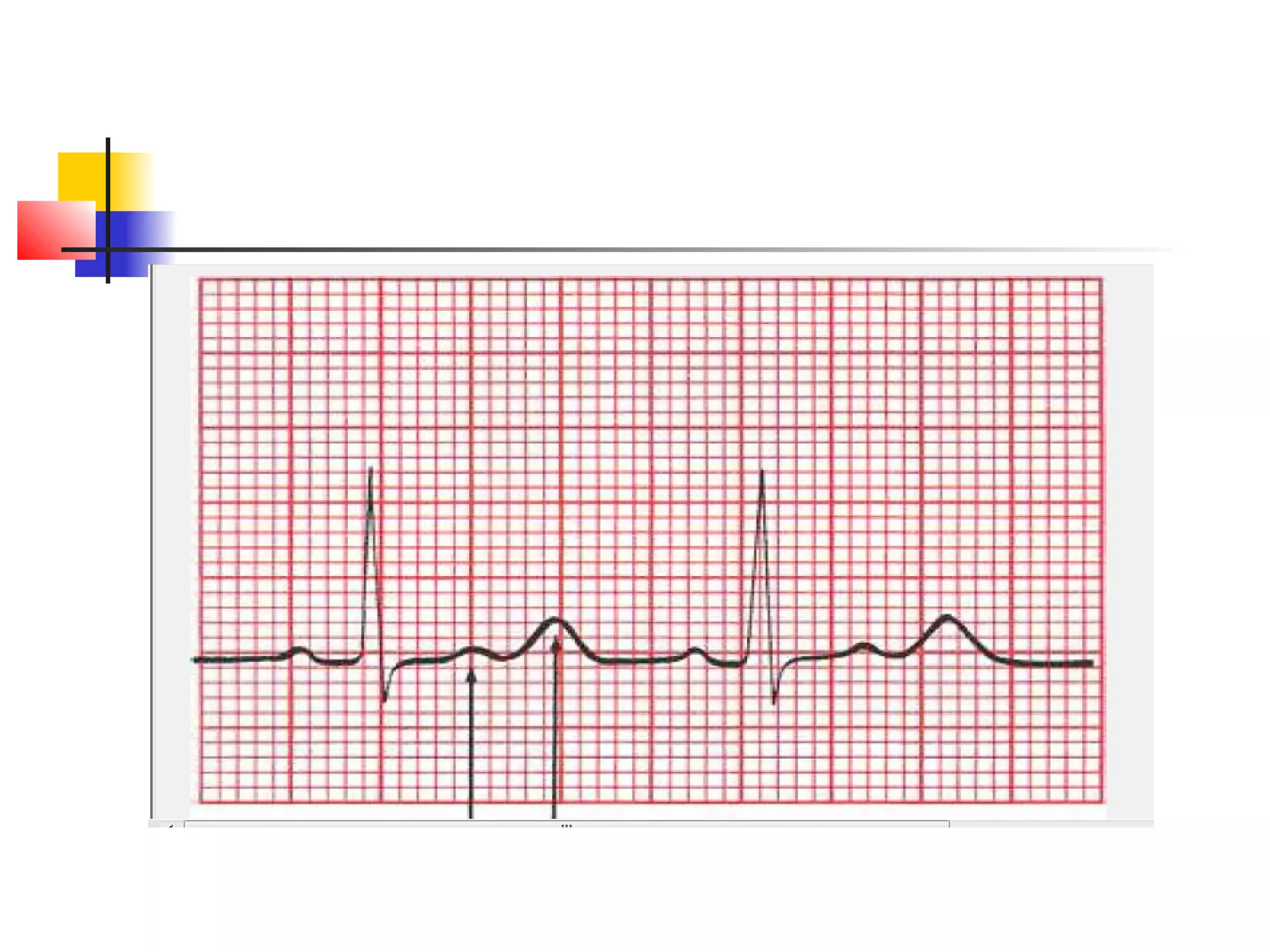 Learn ECG part 2 | PPT