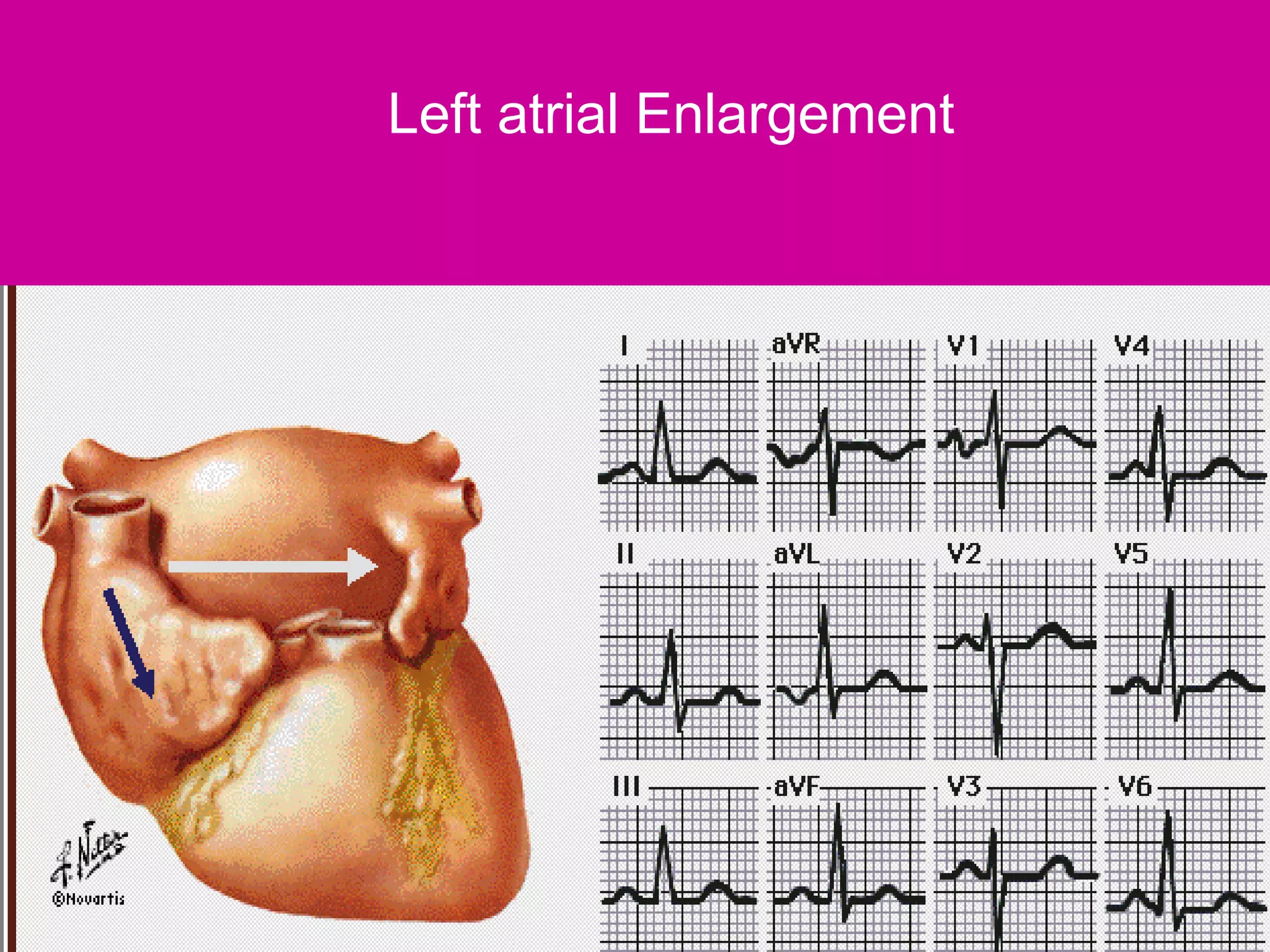 Ecg pediatric | PPTX