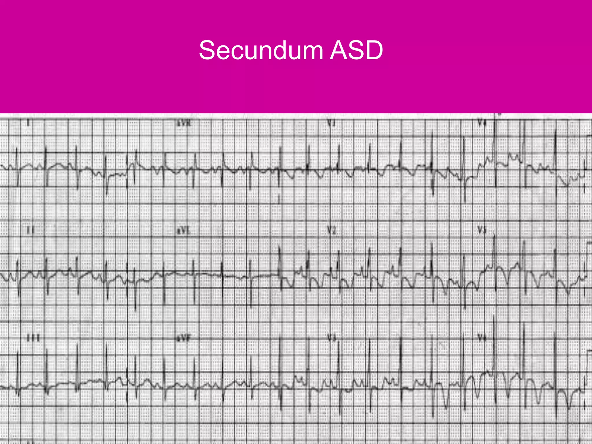 Ecg pediatric | PPTX