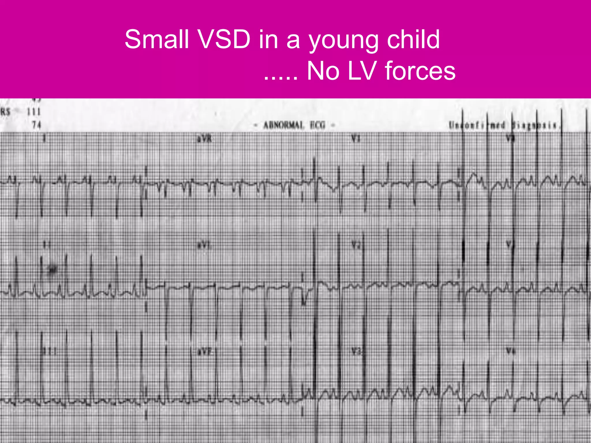 Ecg pediatric | PPTX