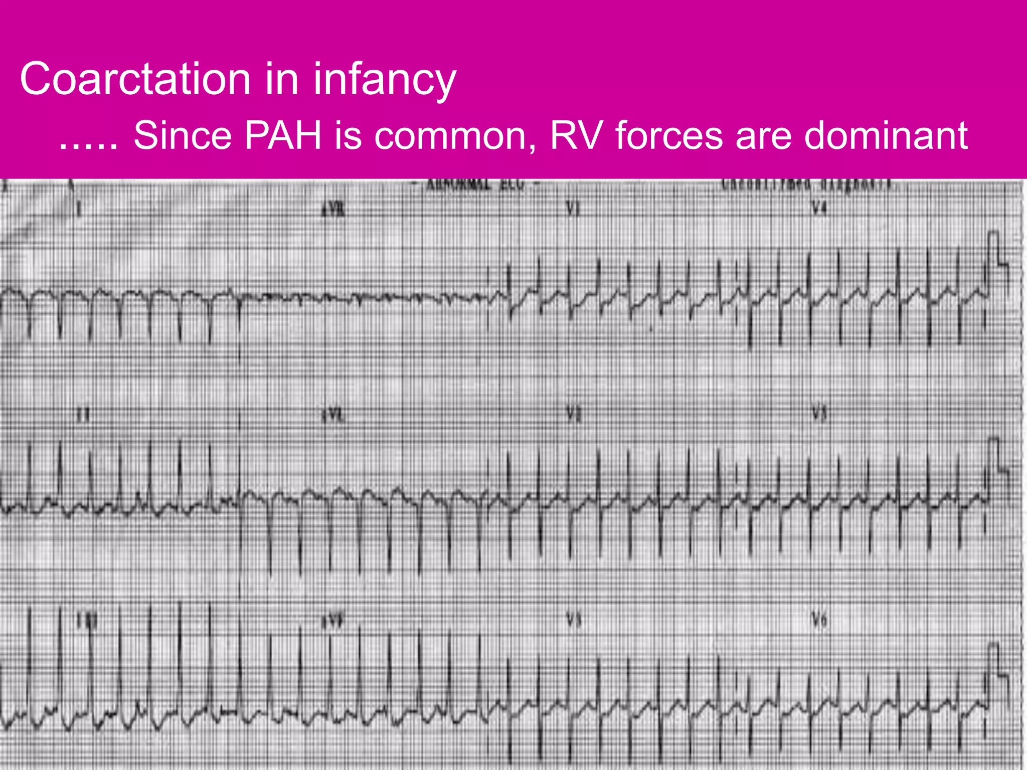 Ecg pediatric | PPTX