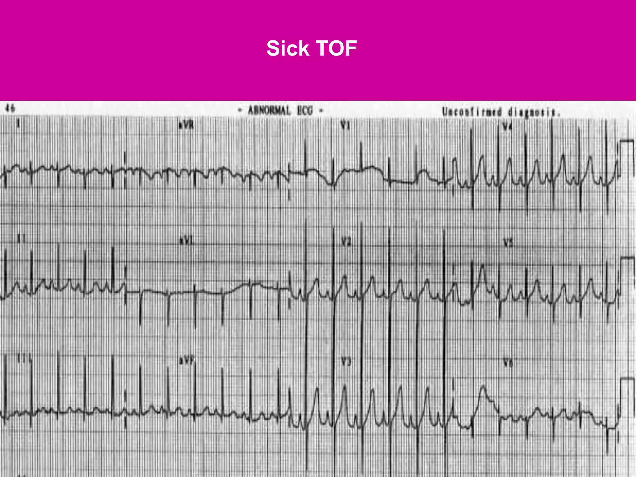 Ecg pediatric | PPTX