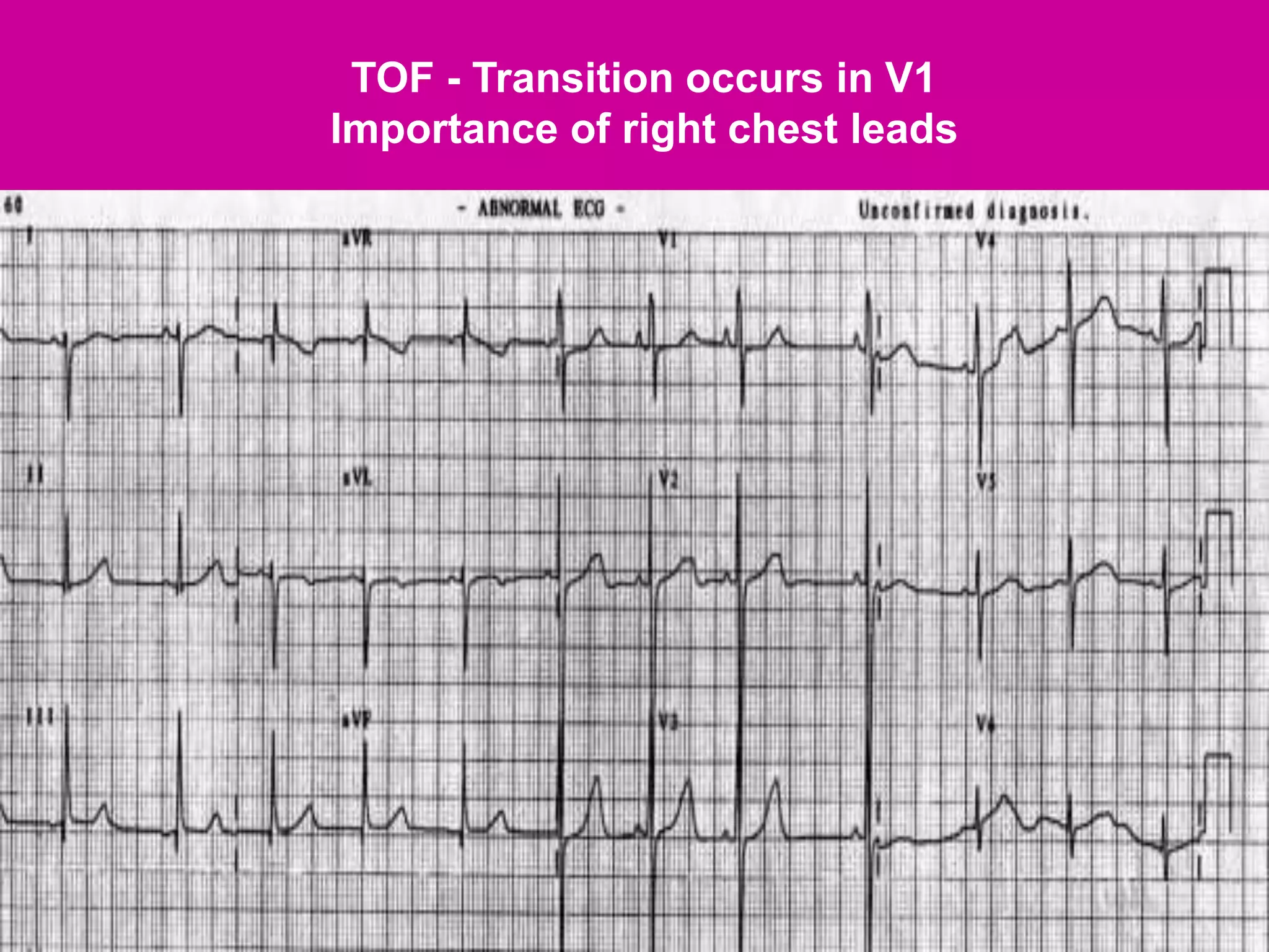 Ecg pediatric | PPTX