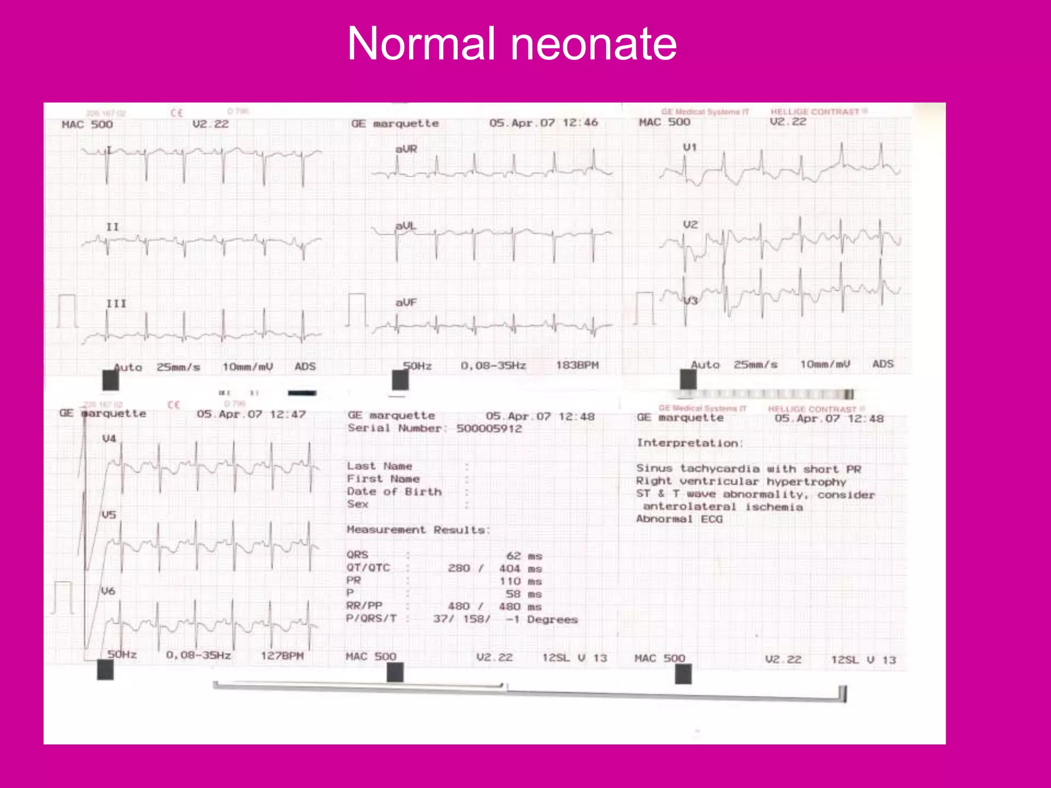 Ecg pediatric | PPTX