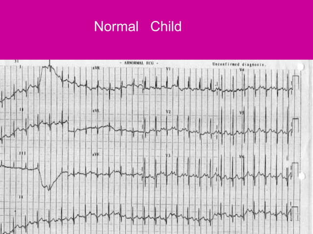 Ecg pediatric | PPTX