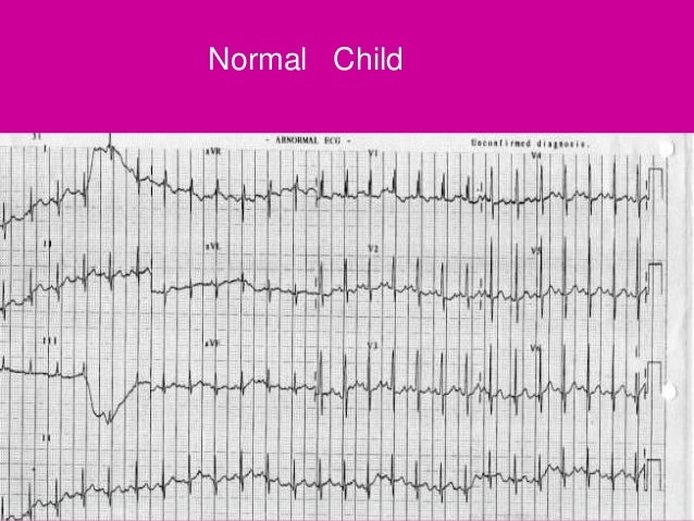 Ekg Children