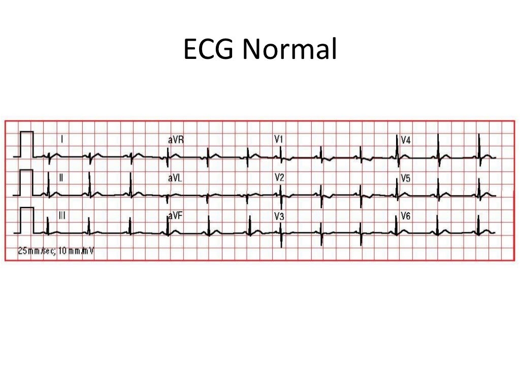 Ecg pediátrico