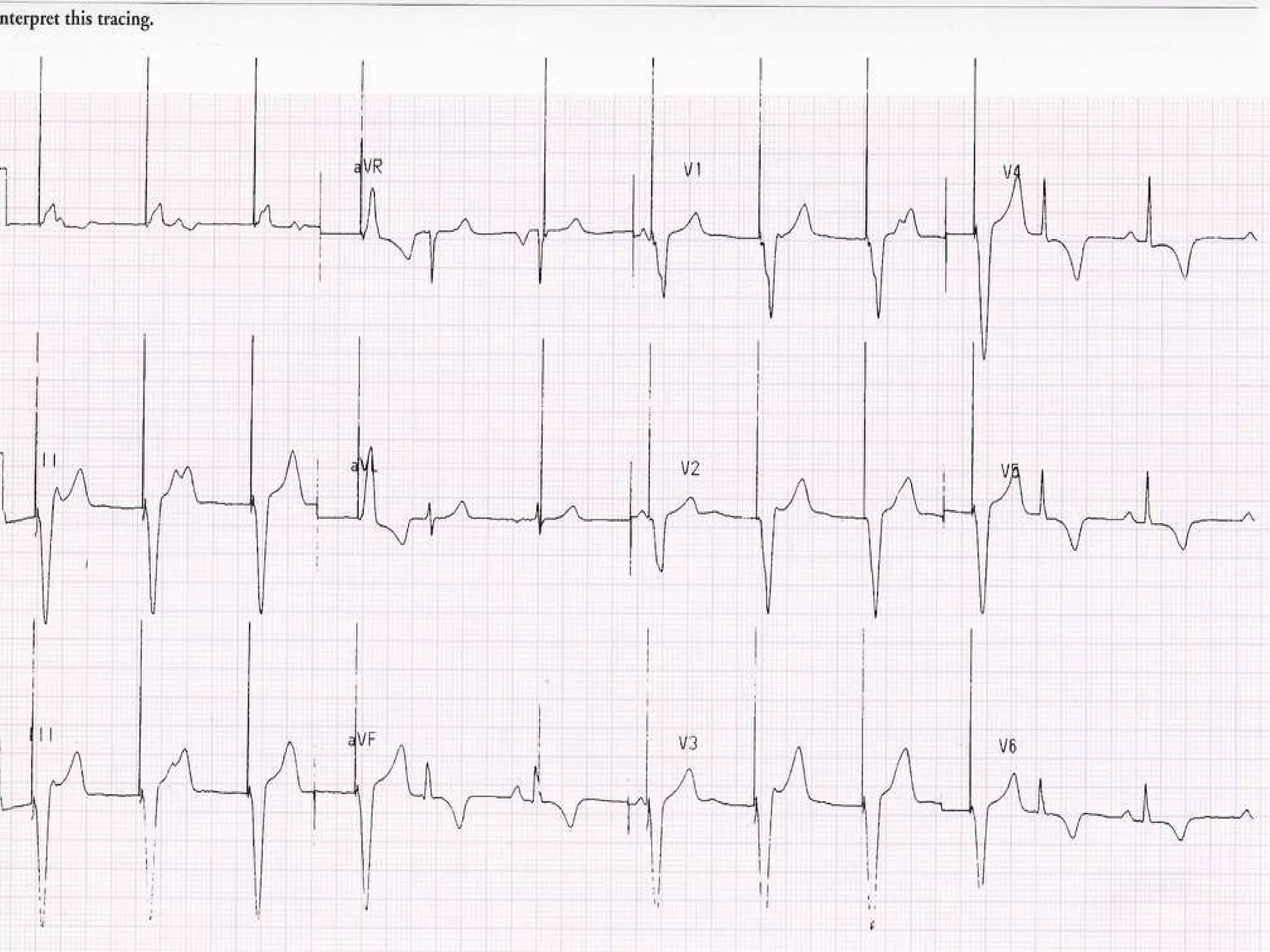 ECG PPI, ASD | PPT