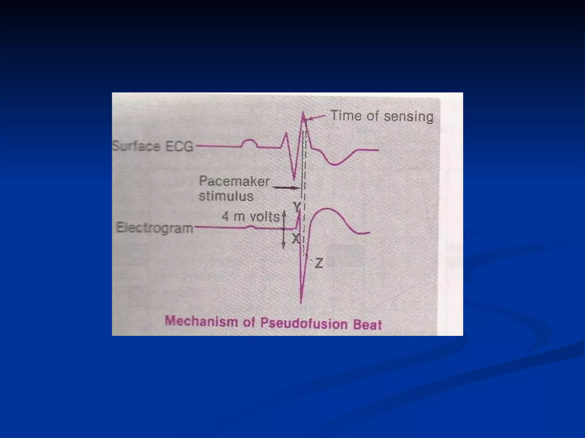 ECG PPI, ASD | PPT