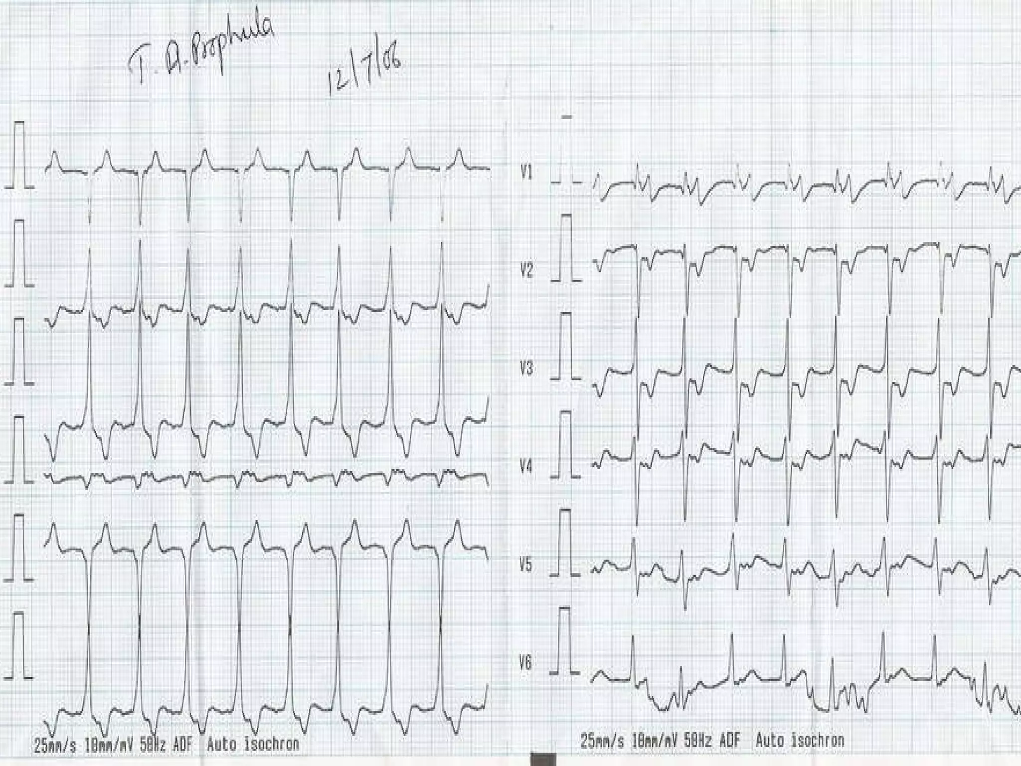 ECG PPI, ASD | PPT