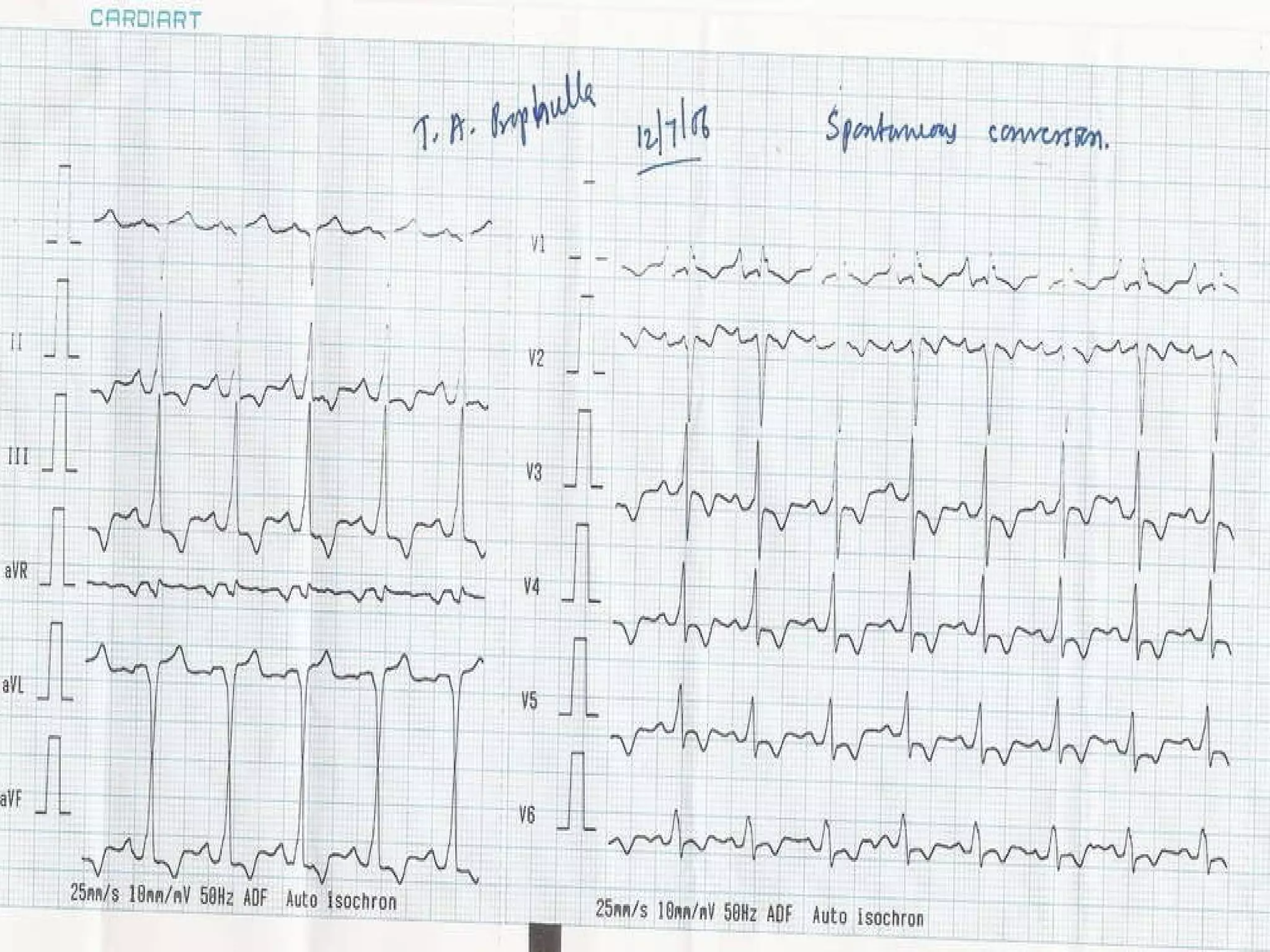 ECG PPI, ASD | PPT