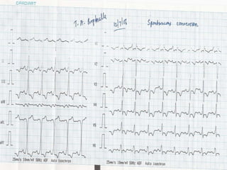 ECG PPI, ASD | PPT