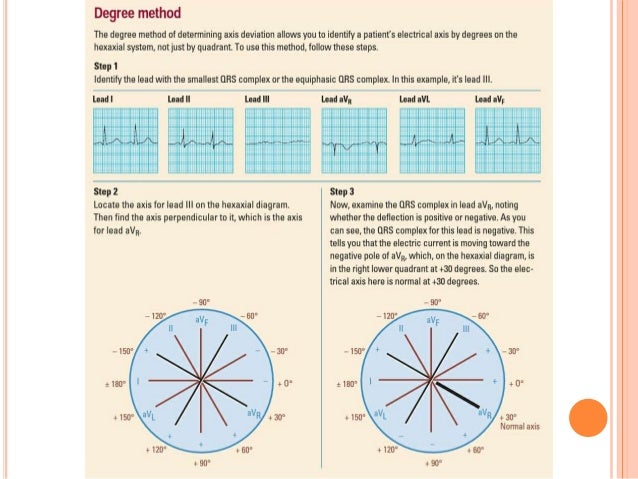 Basic of ECG and Easy Interpretation