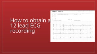 ECG basics an introduction to rhythm recognition | PPTX