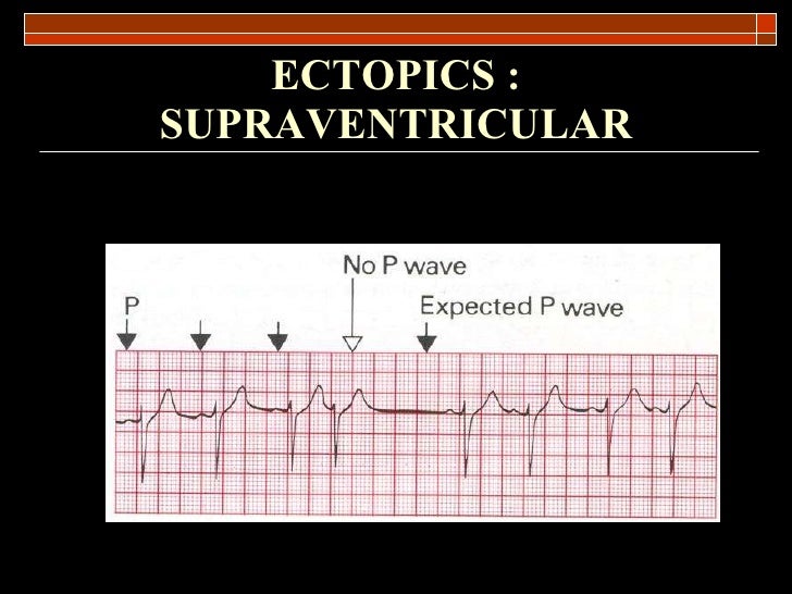 Ecg presentation