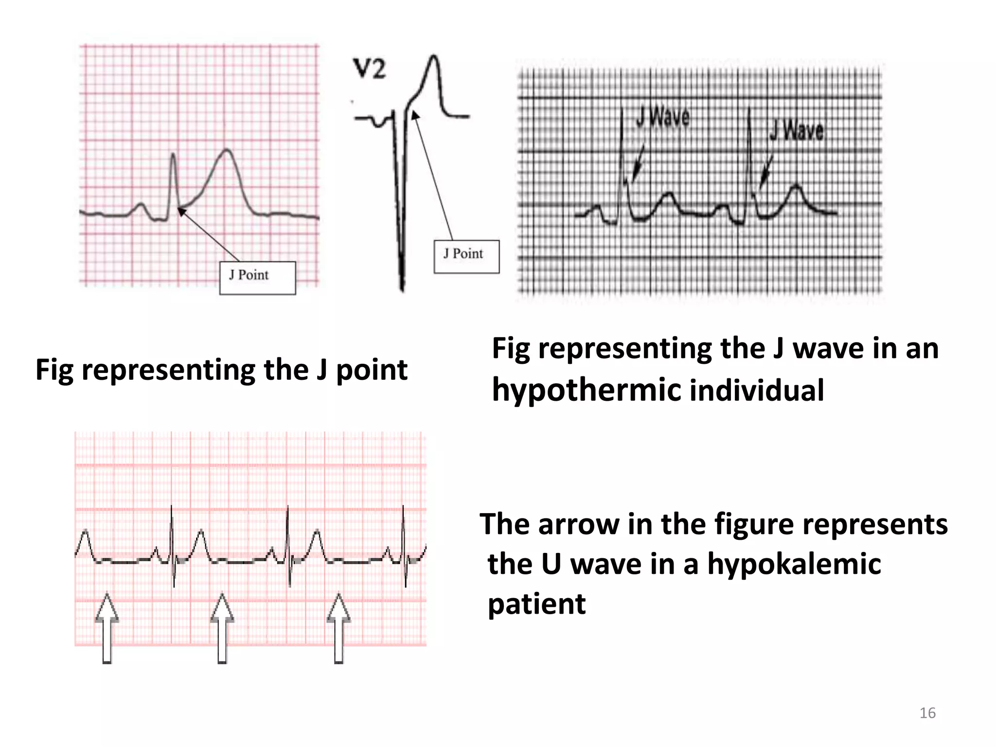ELECTROCARDIOGRAPHY (ECG) | PPTX