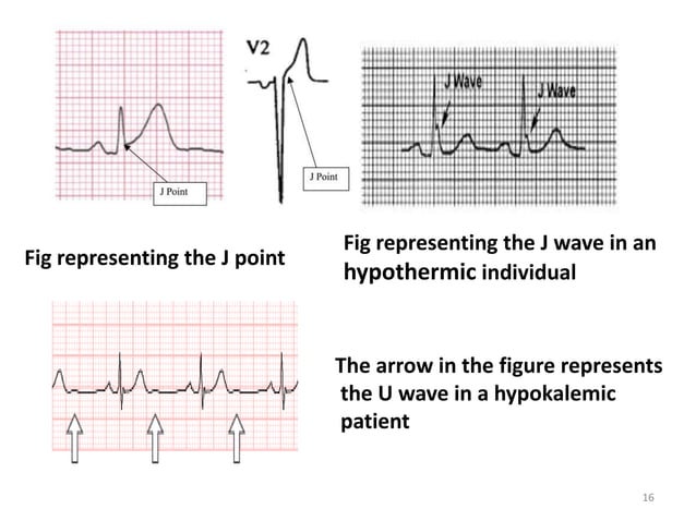 ELECTROCARDIOGRAPHY (ECG) | PPTX | Heart and Cardiovascular Diseases ...
