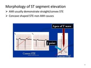 Concave Vs Convex Ecg