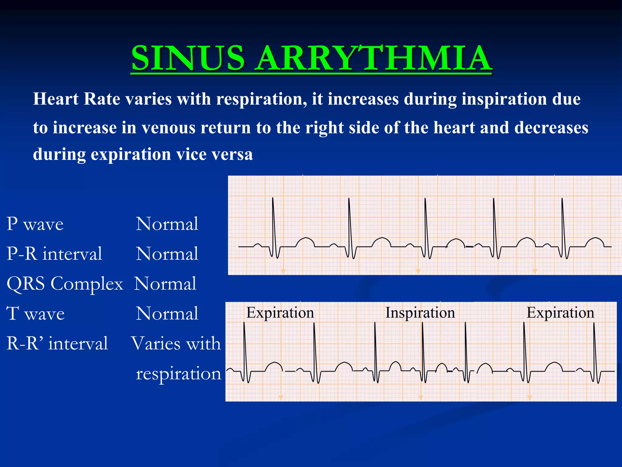 Ecg presentation | PDF