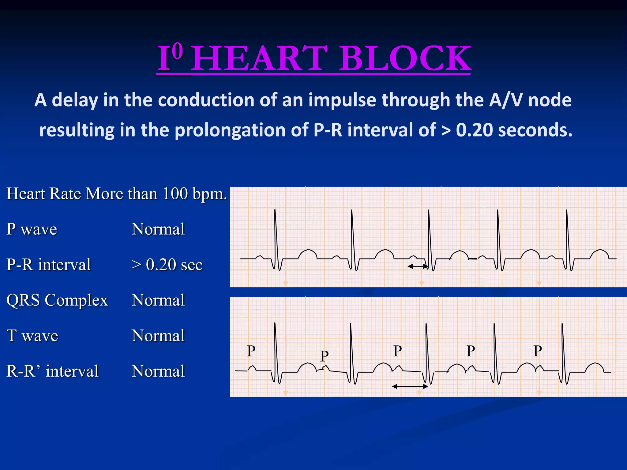 Ecg presentation | PDF