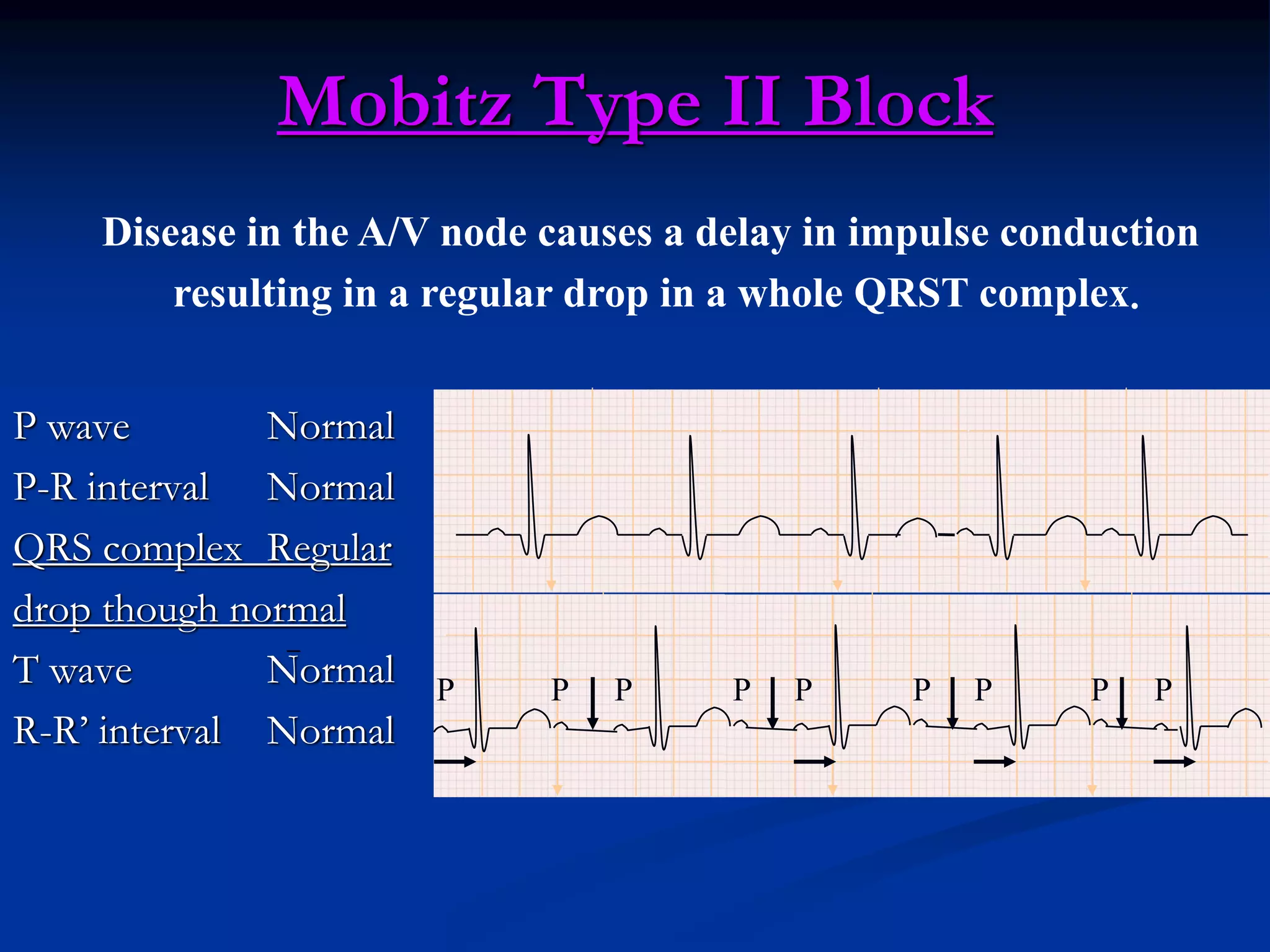 Ecg presentation | PDF