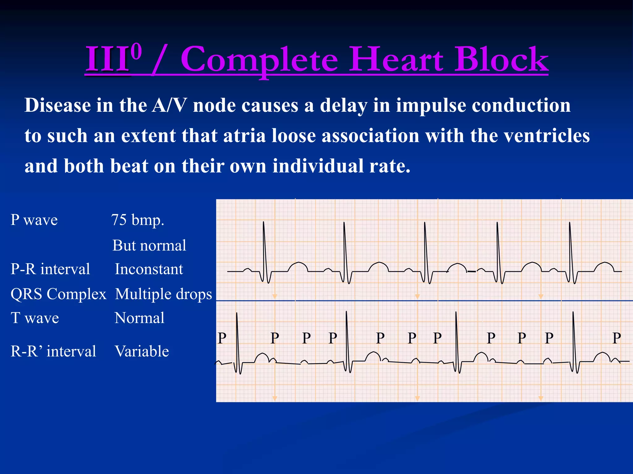 Ecg presentation | PDF