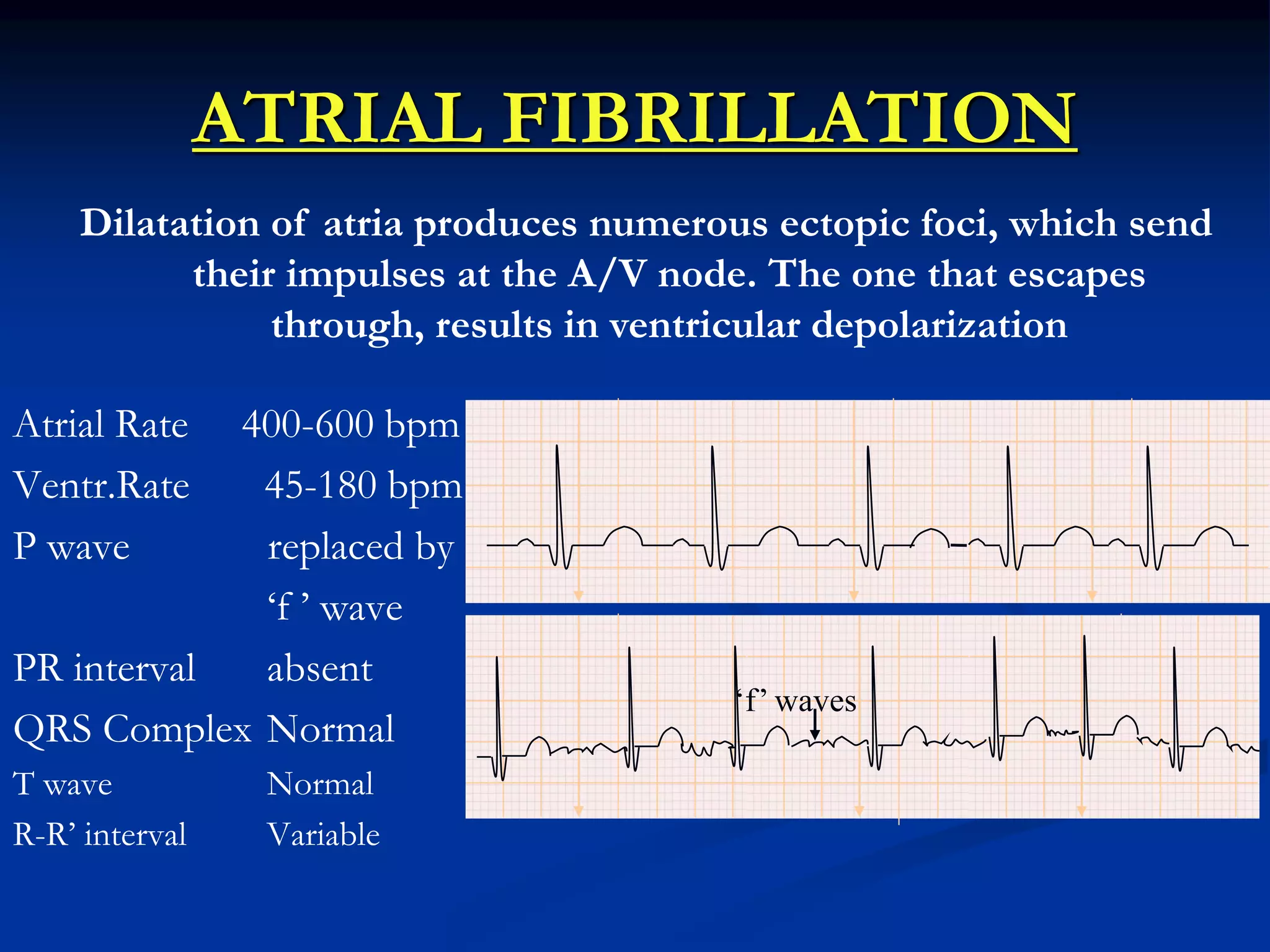 Ecg presentation | PDF